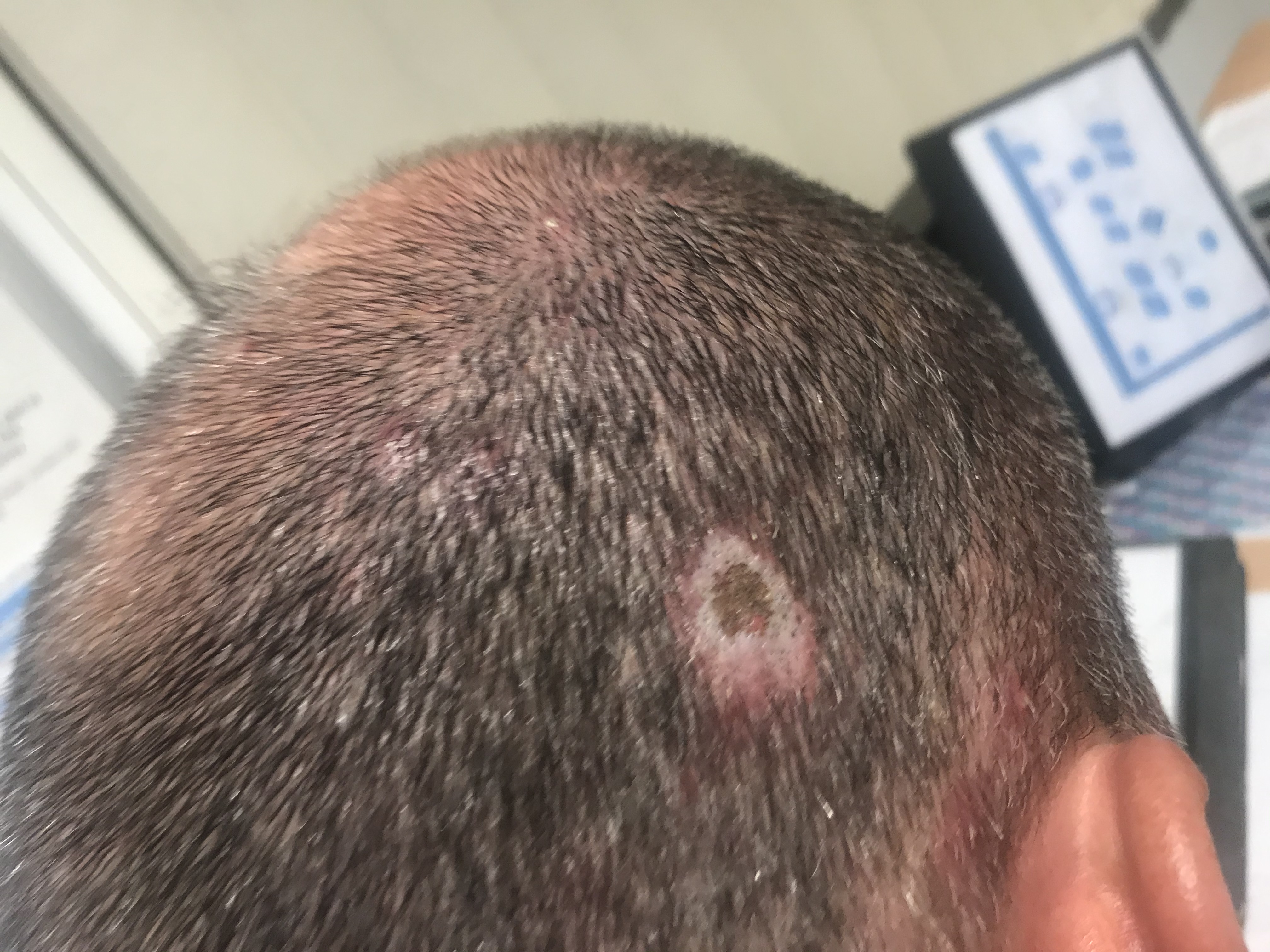 Firefighter of 30 years suffers burn to head after being hit by ...