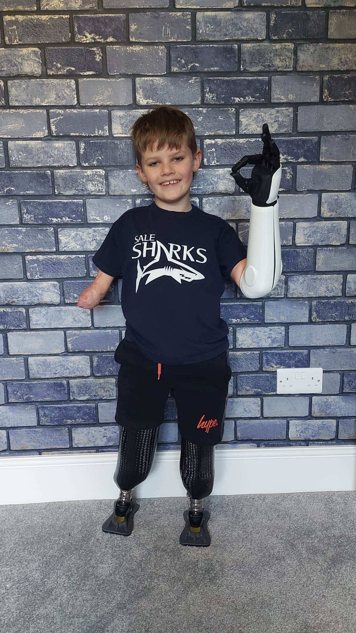 Meningitis survivor from Skipton gets bionic arm | News - Greatest Hits ...