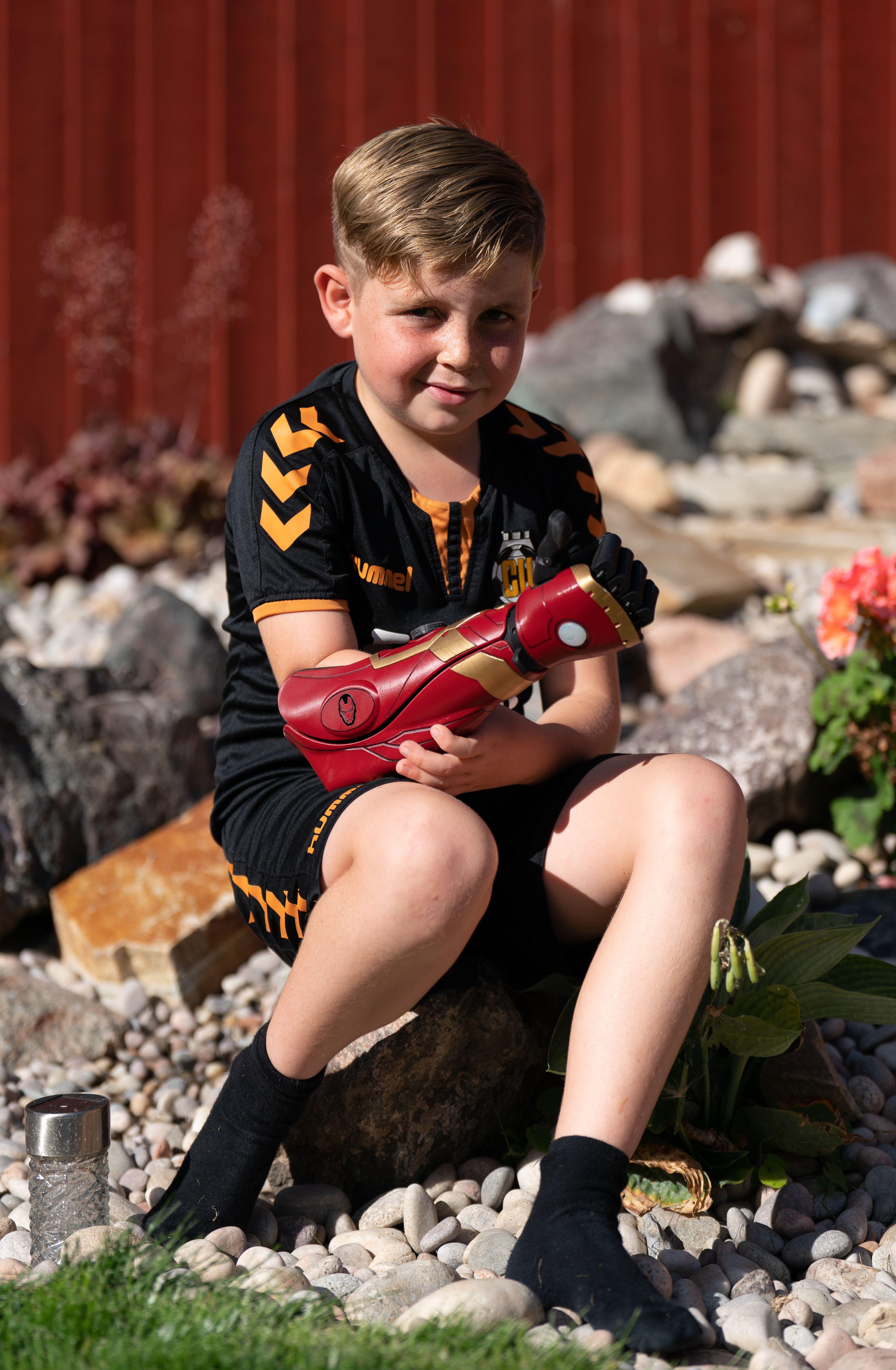 Cambridgeshire boy without right hand receives bionic arm