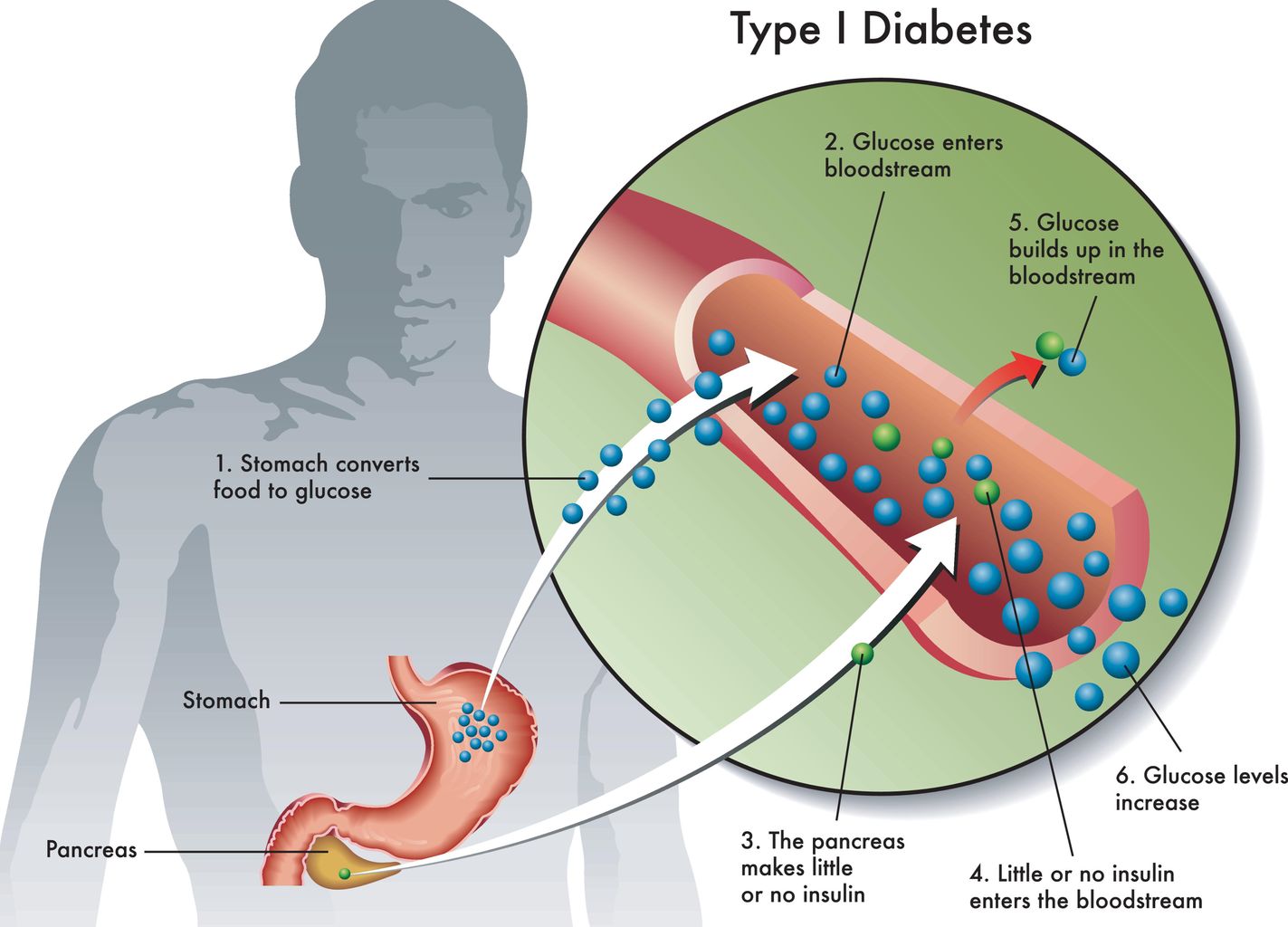 University of Exeter research 'could transform type 1 diabetes | News ...