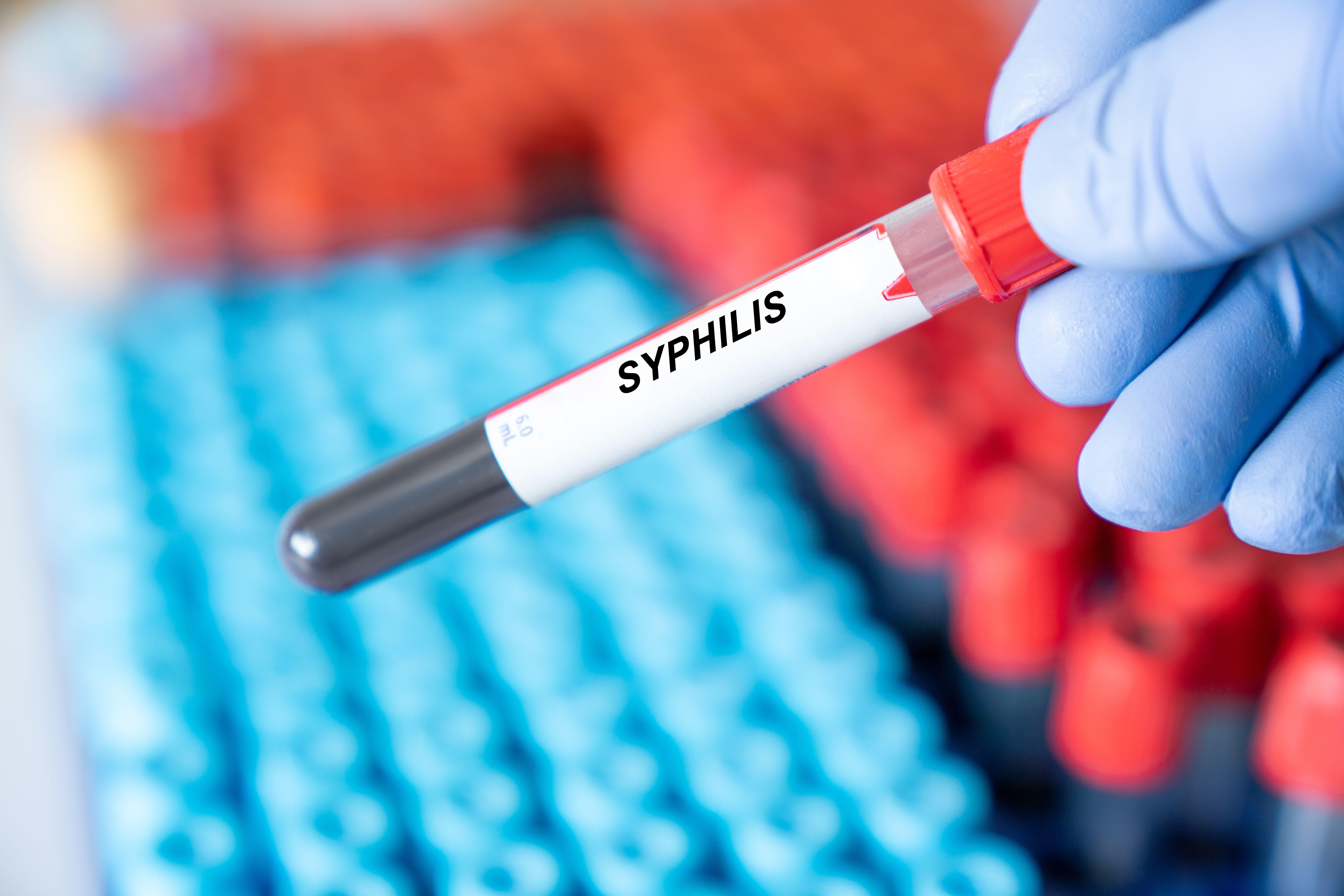 Health warning after "huge" rise in Syphilis cases in West Midlands