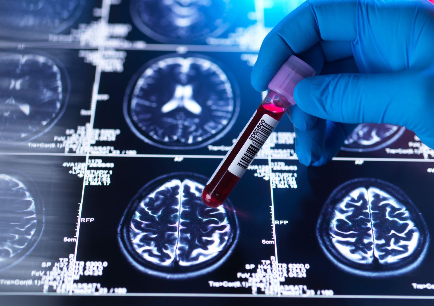 Alzheimer's drug rejection 'understandable' says Wiltshire charity