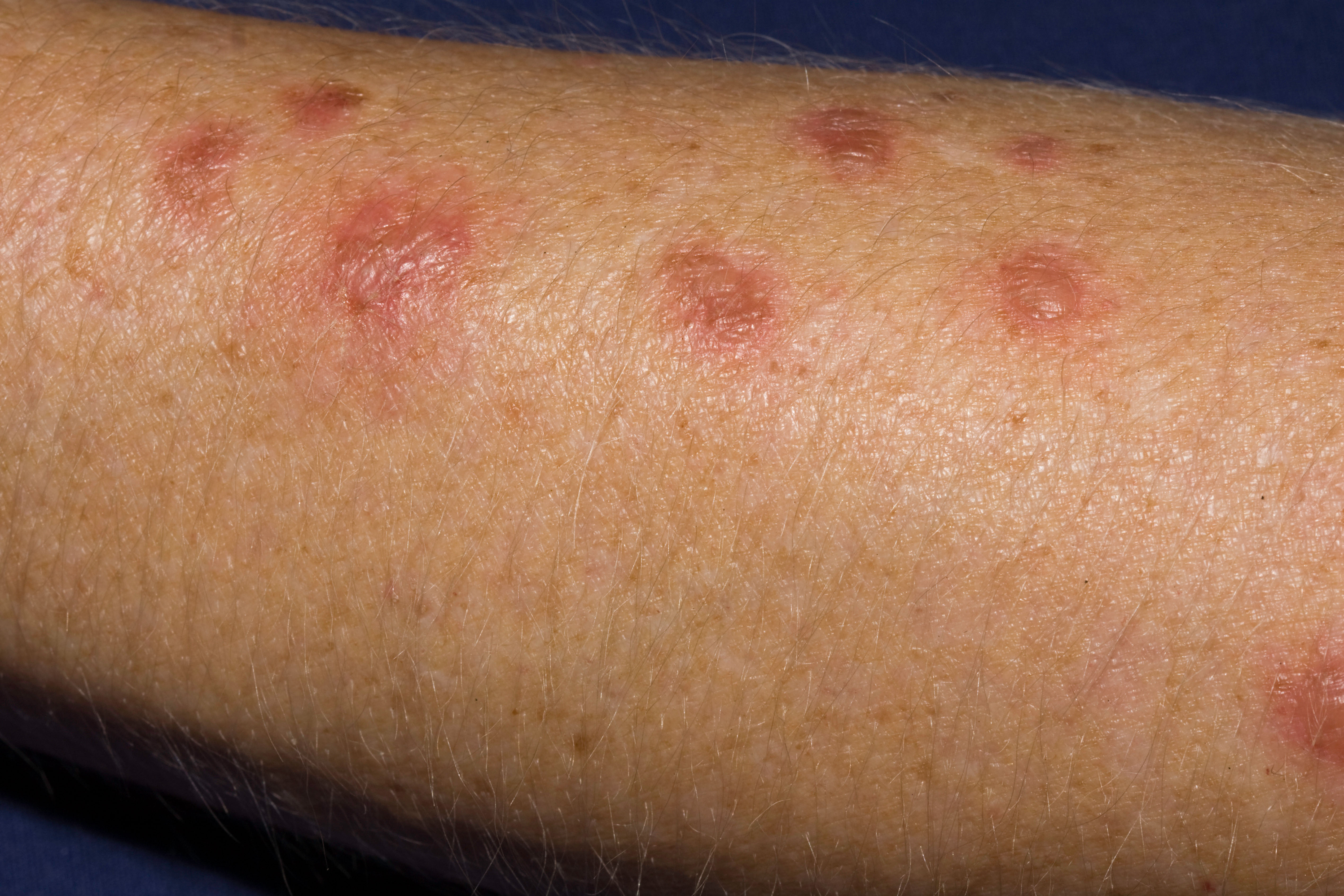 Dorset scientists developing new portable tests for skin cancer