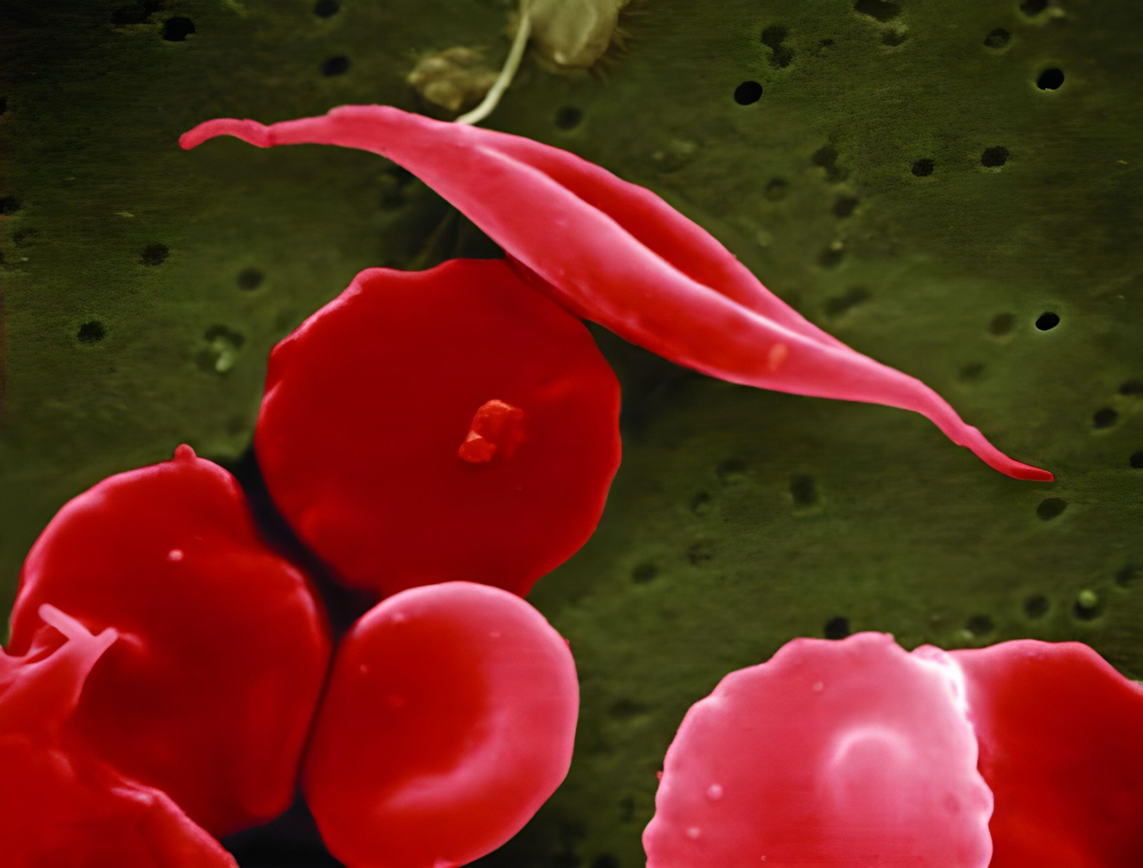 New £1.65m sickle cell treatment to be offered on NHS in Birmingham