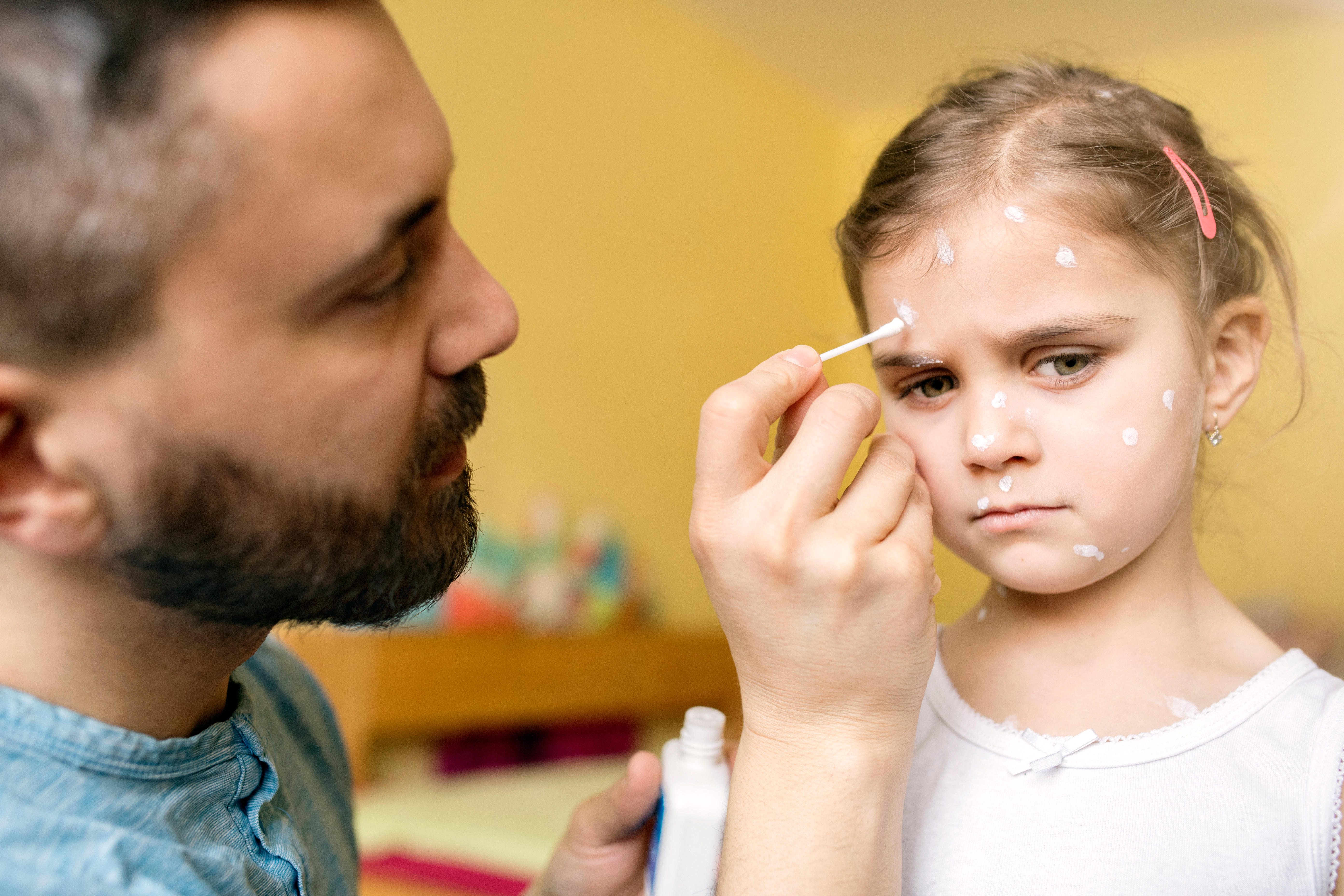 Chickenpox vaccine to be rolled out on the NHS for the first time ...