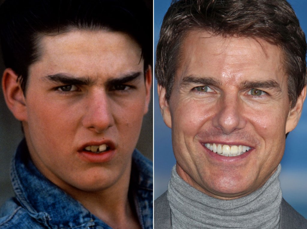 Celebrity Teeth Before And After